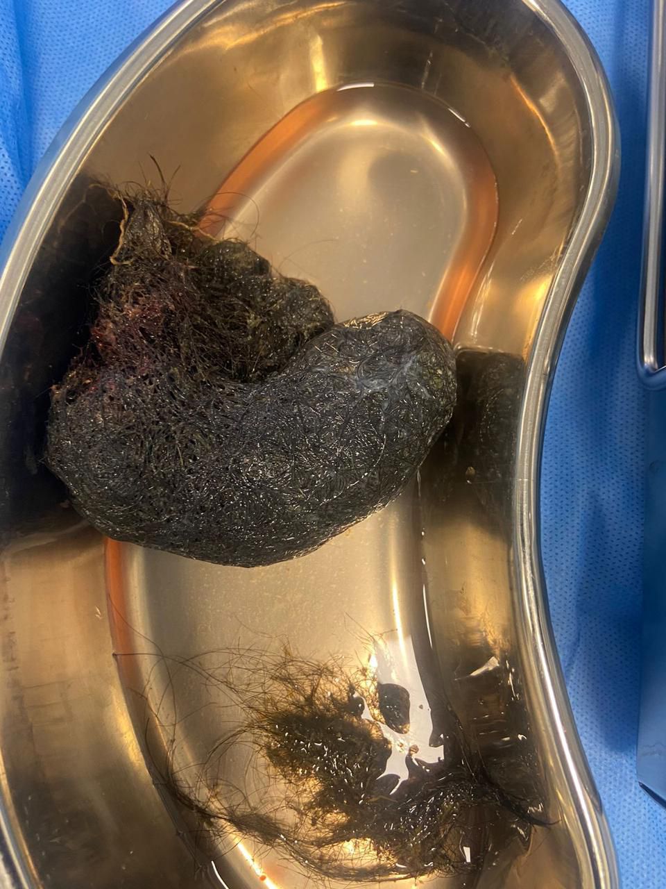 A Hair-Raising Tale: Doctors Remove Massive Hairball from Child’s ...